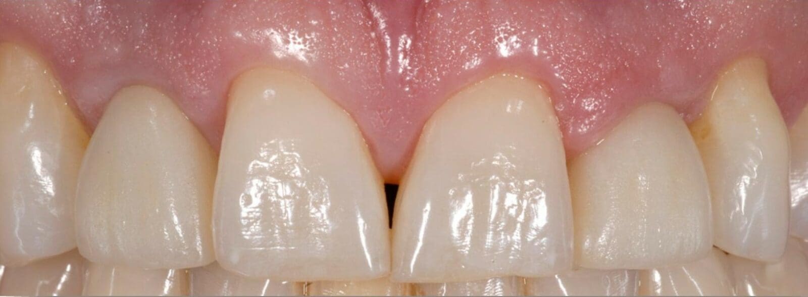 Dental Implants – Advanced Implants & Periodontics